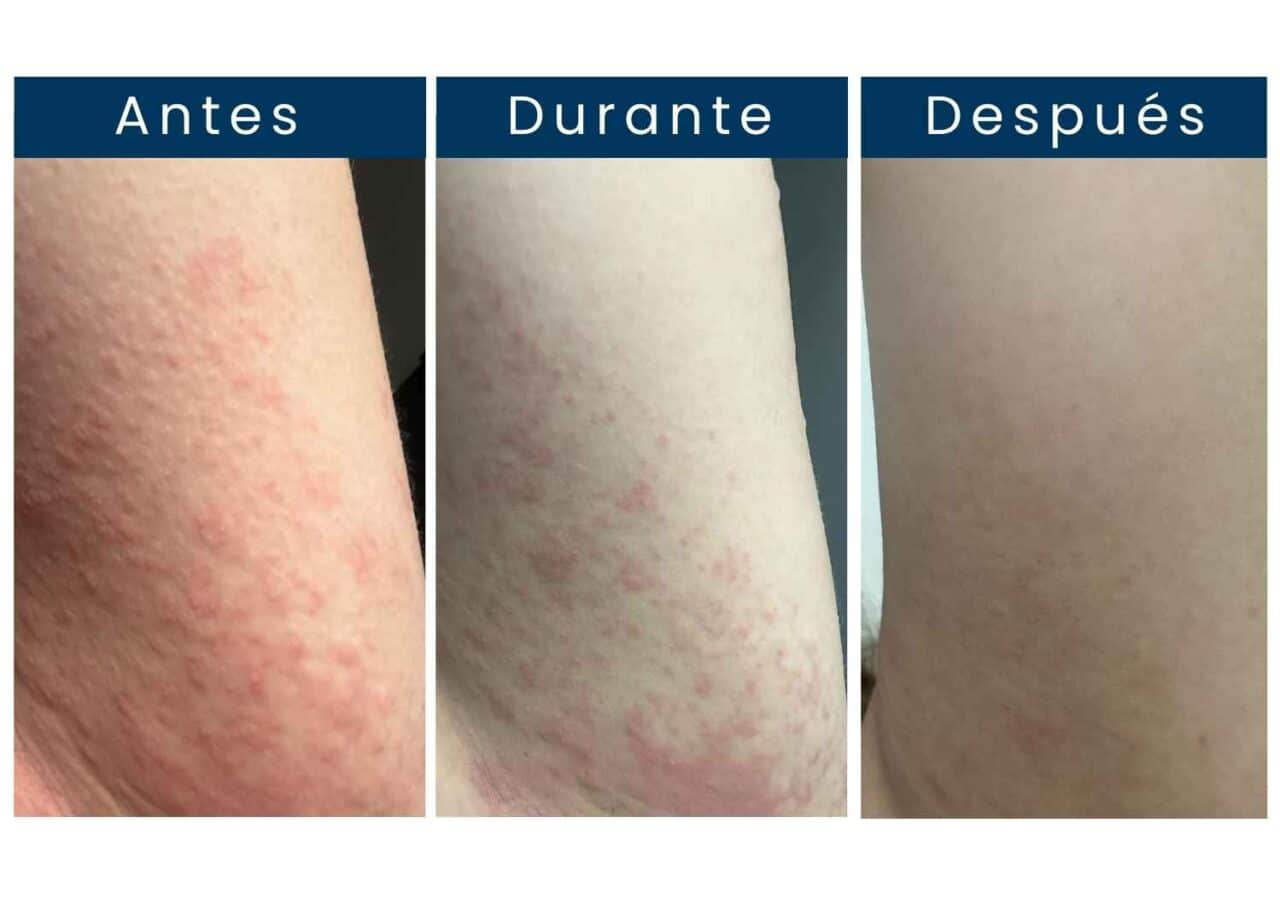 Alergia a los medicamentos - Dr. Daniel Amaya - Médico Alergólogo